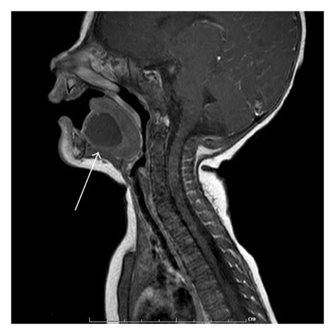 Sagittal T Weighted Mri Demonstrating Cystic Component Open I My Xxx Hot Girl