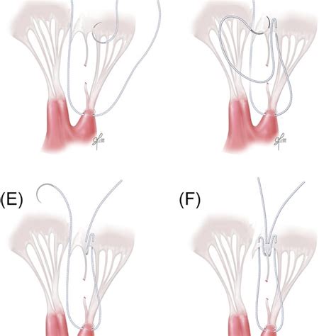 Mitral Valve Repair By A Quadrangular Resection Technique With Download Scientific Diagram