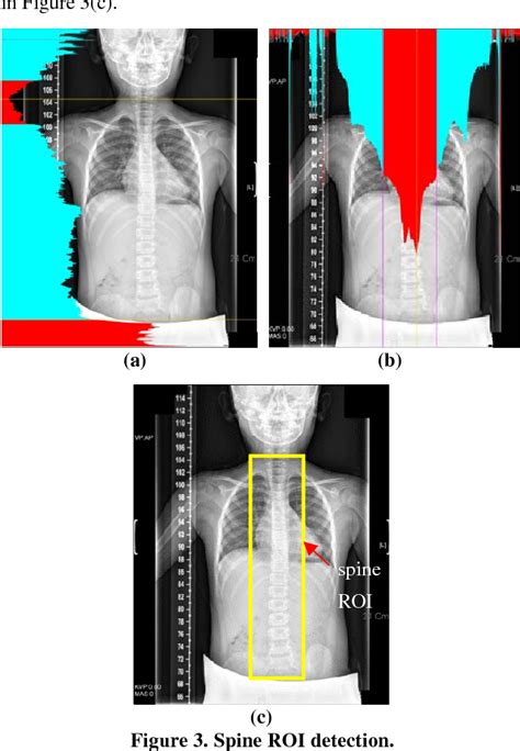 Figure 5 From Vertebrae Segmentation From X Ray Images Using