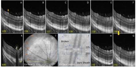 Effect Of Suboptimal Dispersion Correction Parameters Figs 1 A I