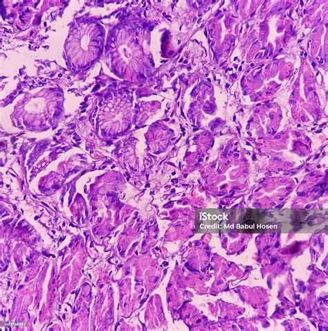 위 몸의 현미경 이미지 과형성 용종 위 점막 팽창 된 위선의 Polypoid 성장 및 Oedematous Stroma를 보여줍니다 조직학에 대한 스톡 사진 및 기타 이미지