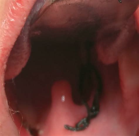 Right Tonsillar Bed After Hemostasis Using Silk Sutures And The Left