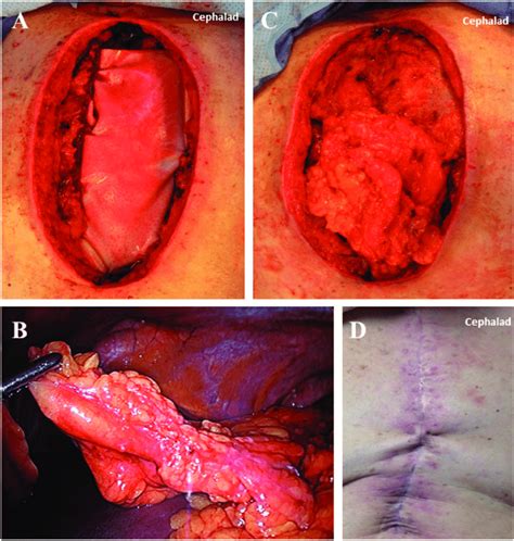 A Strattice Mesh Placement B Laparoscopically Harvested Omental