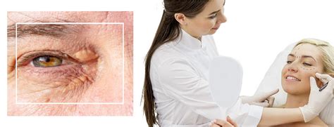 Rimozione Xantelasma Pulsinelli Medical Center