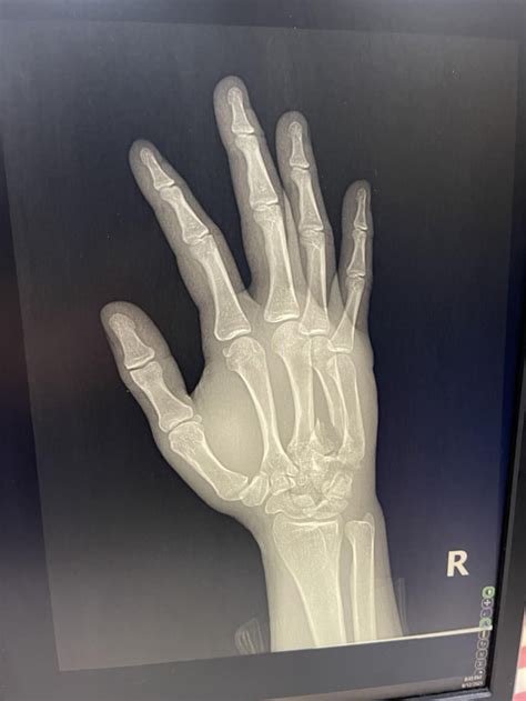 I Broke My 4th Metacarpal And Dislocated My 5th One Rxrayporn