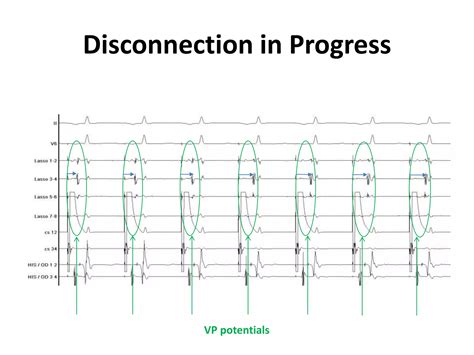 Atrial Fibrillation Cryoablation Esophagus Pptx Surgery Medical Health