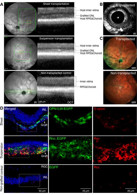 Video Transpupillary Guided Trans Scleral Transplantation Of Subretinal Grafts In A Retinal