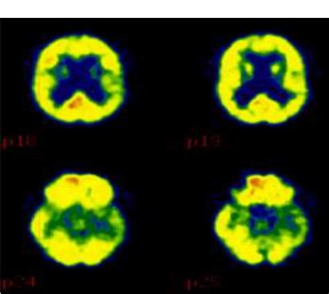 Figure 22 From Multimodal Image Fusion By Using Non Subsampled Contourlet Transform Semantic