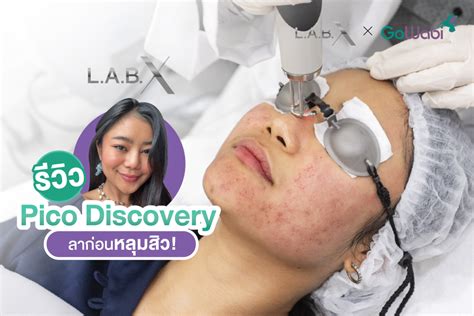 ลาก่อนหลุมสิว รีวิว L A B X Clinic Pico Discovery คุ้มมากกก