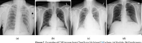 Figure 1 From A Review Of Recent Advances In Deep Learning Models For Chest Disease Detection