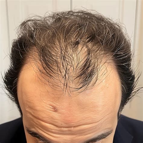 Treatment For Hair Loss Male Getting A Hair Loss Treatment Man With Hair Loss Problem Premium