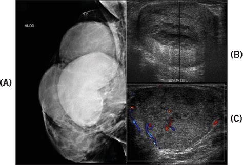 Figure 3 From Malignant Phyllodes Tumor Of The Breast Case Report Semantic Scholar