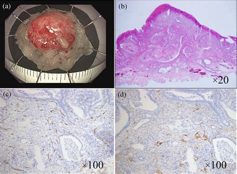 Endoscopic Submucosal Dissection Procedure For The Isiic Lesion In The