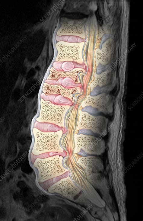 Lumbar Compression Fracture Illustration Stock Image C027 6315 Science Photo Library