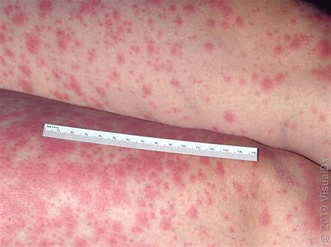 Early Stevens Johnson Syndrome