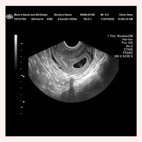 4 Week Ultrasound Ultrasounds