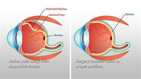 Detached Retina After Cataract Surgery