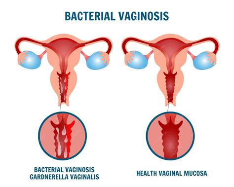 Infografía De Vaginosis Bacteriana En Ilustración Vectorial Vector