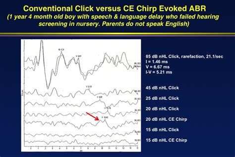 Update On Auditory Evoked Responses Value Of Chirp Stimuli In Abrassr Measurement Article 17434