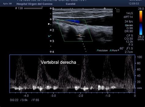 Subclavian Steal Syndrome [feb 2023] Efsumb