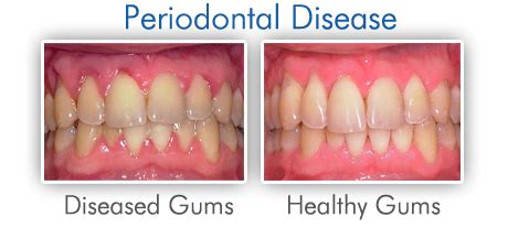 Healthy Gums Color