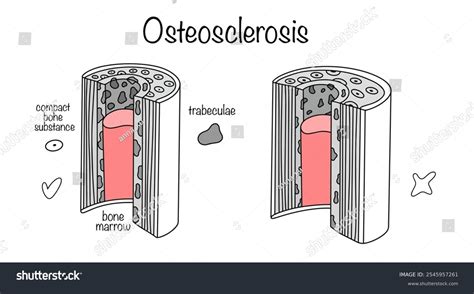 Increase Bone Density Over 33 Royalty Free Licensable Stock