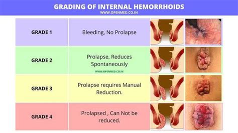 Grading Of Internal Hemorrhoids Medizzy