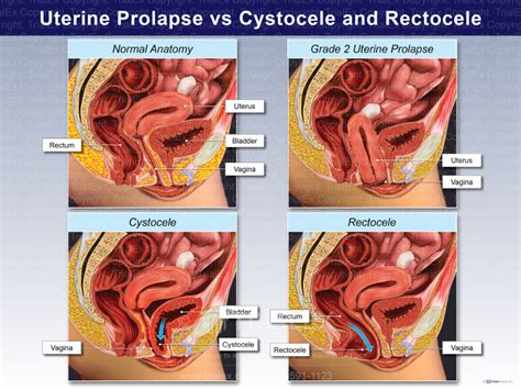 Cystocele Grading