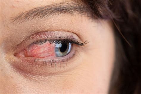 Why Do I Keep Getting Conjunctivitis Maryland Eye Care Center