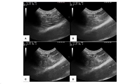 Ultrasonic Imaging Of Rabbit Abdominal Aorta Of Rabbits Injected With