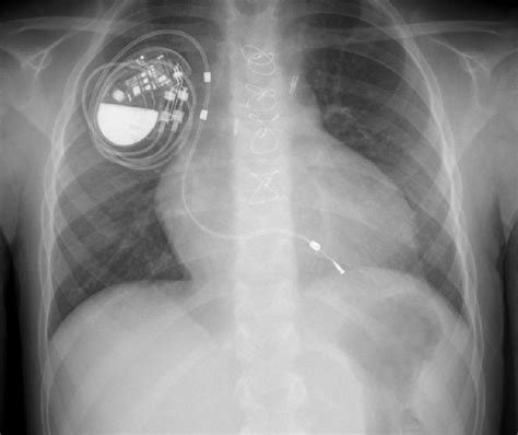 Twiddler Syndrome In A Pediatric Patient Revista Portuguesa De