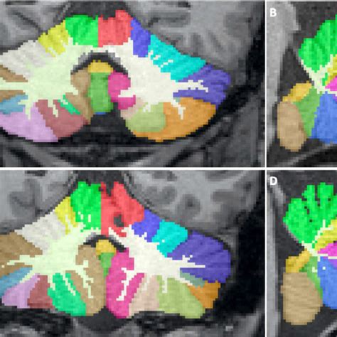 Segmentation Examples Of A Fully Automated Segmentation Of Cerebnet In Download Scientific