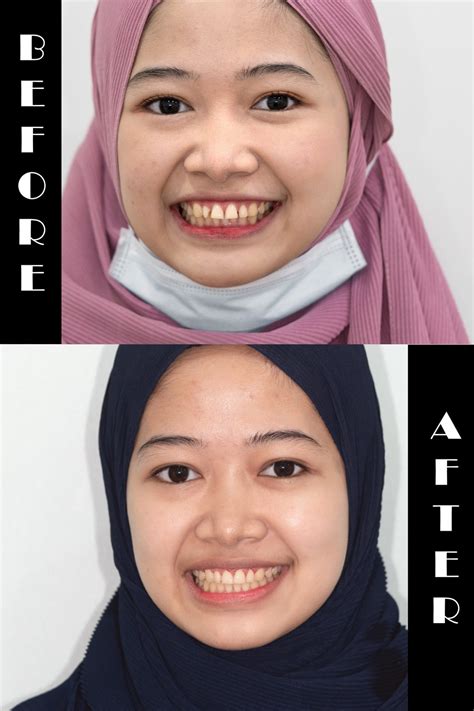 Braces Price Penang At Missy Lynch Blog