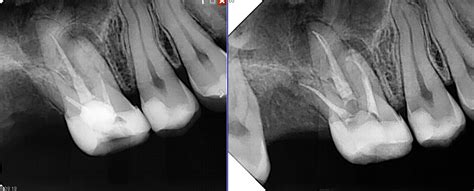 Д р Пламен Славов стоматолог Прелекуване на долен четвърти зъб Пациентът беше изпратен от