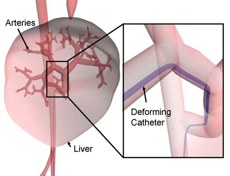 Path Planning For A Deformable Catheter Our Collision Detection Download Scientific Diagram