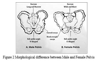 Sex Determination By Pelvis A Mini Literature Review