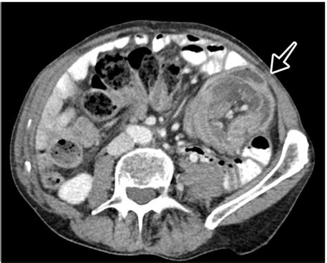 Ct Scan Of The Abdomen Axial Plane Showing An Ileo Colic Download Scientific Diagram