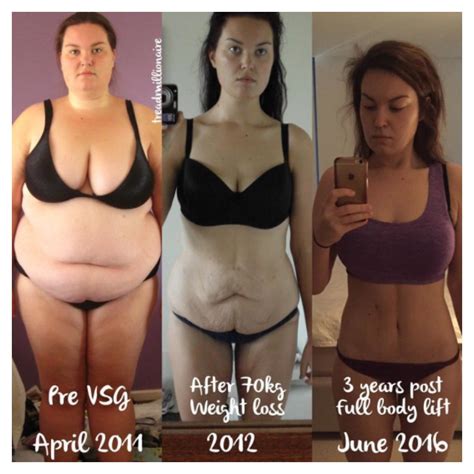 Weight Loss Excess Skin Removal Nhs At Lester Watkins Blog