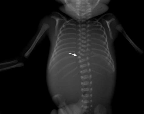 Fetal Hemivertebra A Rare Form Of 18q Deletion Prenatal Presentation