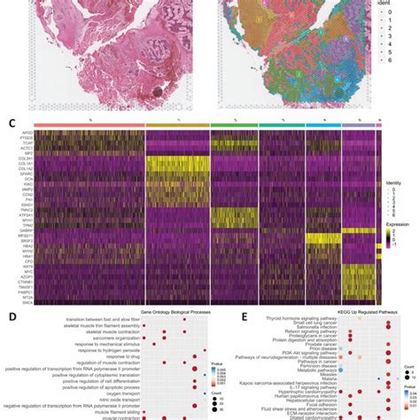 Spatial Transcriptomics Elucidates Lgacc And Surrounding Tissue