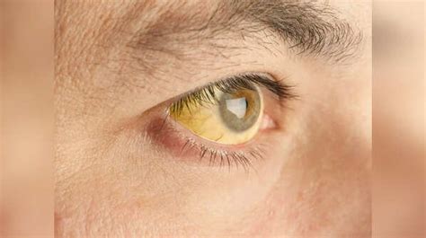 Hepatitis B Risk Through Sex 6 Symptoms Of The Liver Disease That Can Spread Through Sexual Contact