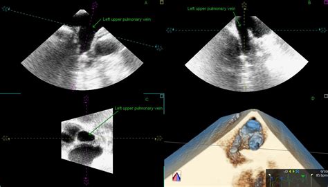 Video Three Dimensional Echocardiographic Method For The Visualization