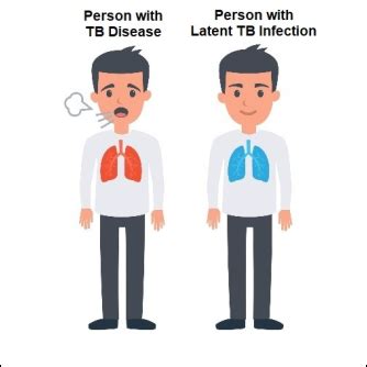 Differences Between Latent Tb Infection And Tb Disease
