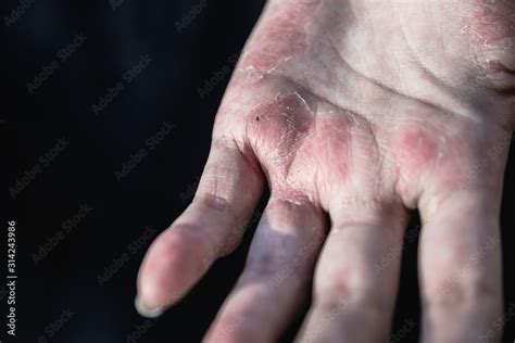 Skin Healthy Care Seborrheic Dermatitis On Hand In Young Woman Stock