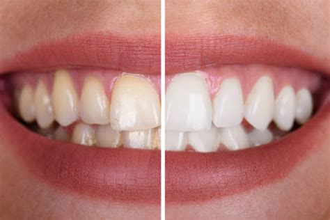 Are Stained Teeth Hereditary Fort Myers Dentist Total Dental Solutions