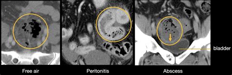 Abdominal Ct Diverticulitis • Litfl • Radiology Library