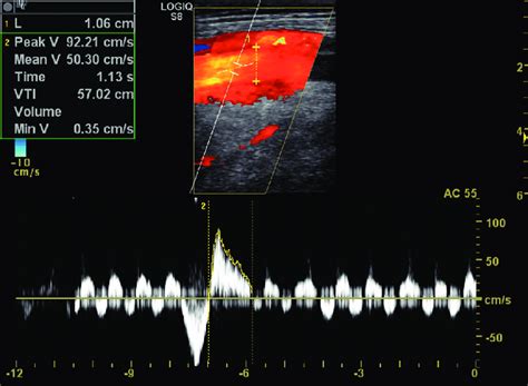 Spontaneous Retrograde Pulsatile Flow Combined With Venous Reflux