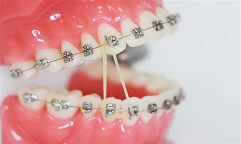 8 Consejos Que Debes Seguir Cuando Llevas Ortodoncia