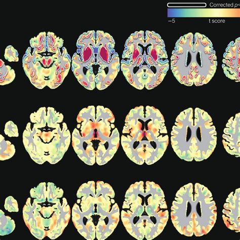 Effects Of Demographic Factors On Regional Brain Glucose Metabolism A Download Scientific
