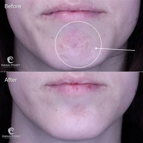 Botulinum Toxin Injections Women Before And After Dana Point Dermatology